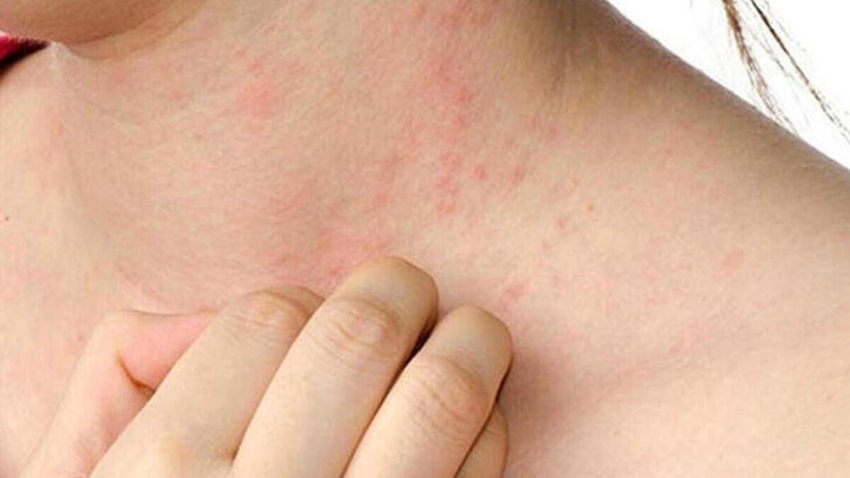 Kaşıntıya Hangi Krem İyi Gelir? En Etkili Kaşıntı Kremleri ve Kullanım ...